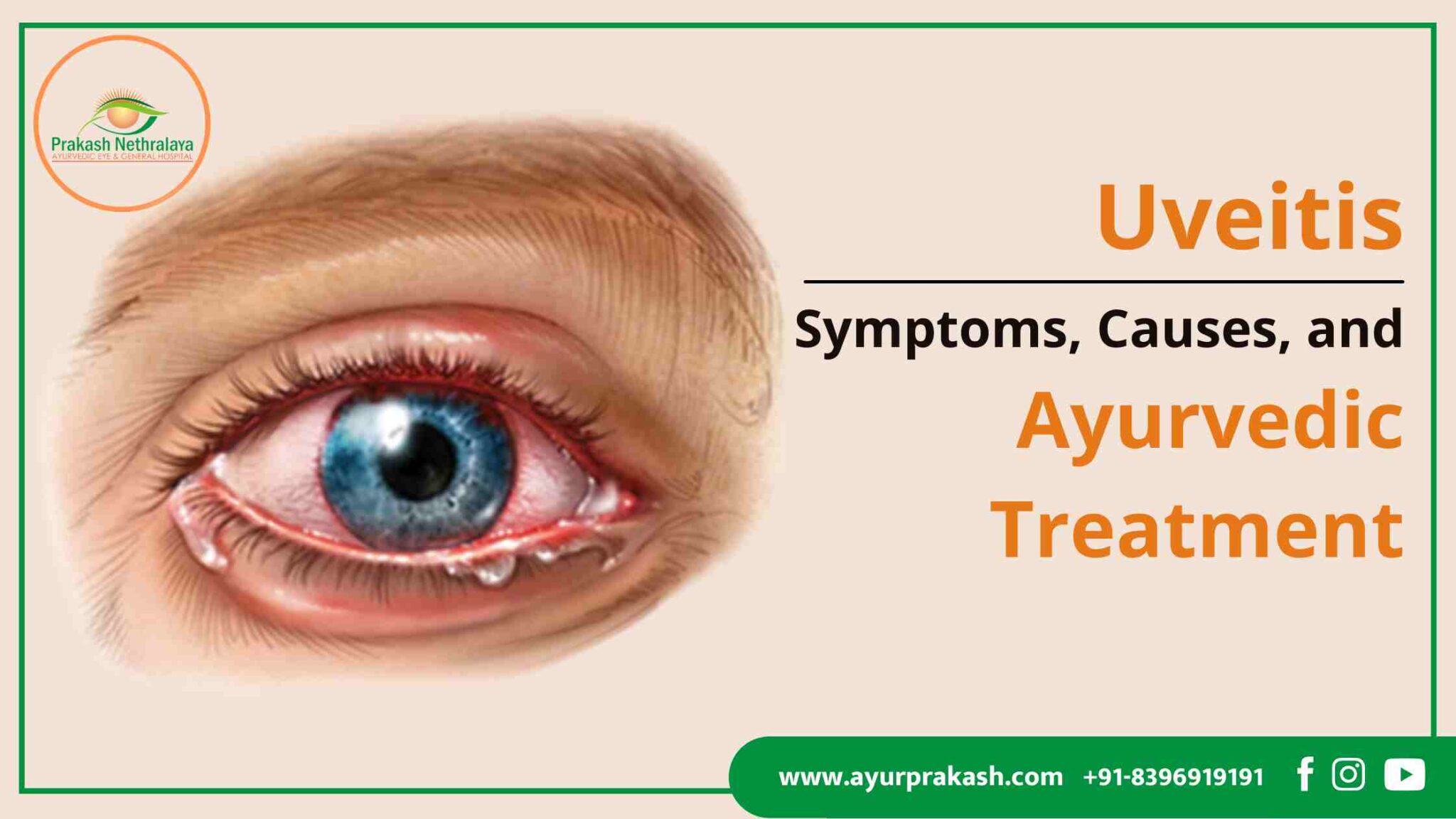 Guide to Uveitis its Symptoms, Causes & Ayurvedic Treatment