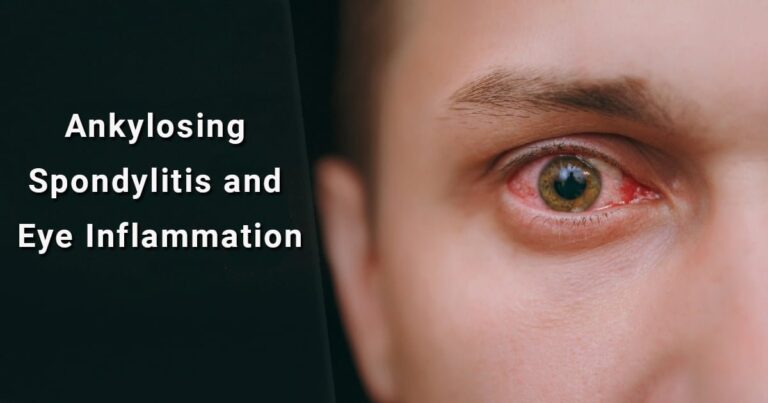 Ankylosing Spondylitis and Eye Inflammation: What You Should Know