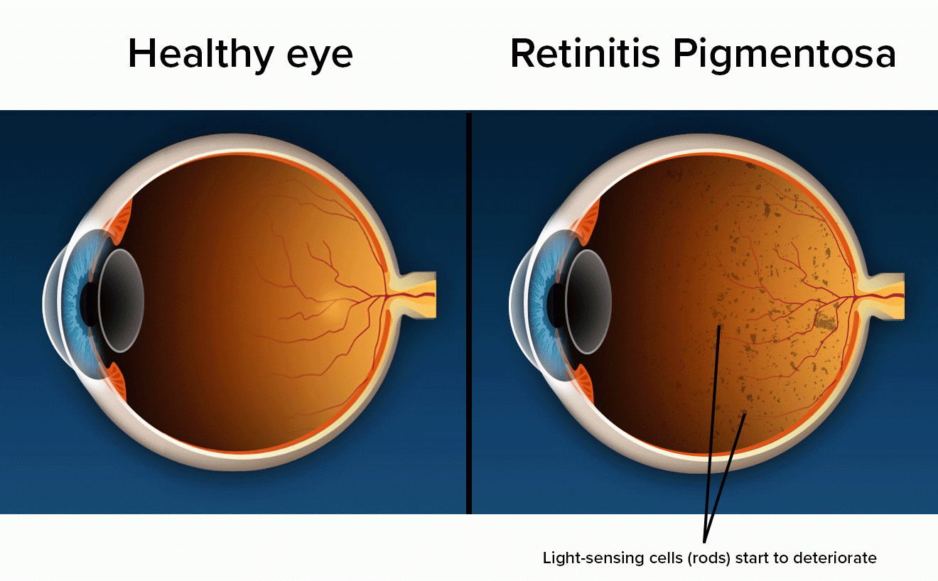 10 Tips to Manage Life with Retinitis Pigmentosa