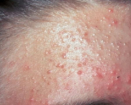 Ayurvedic Treatment for Acne | Pimple & Acne Removal Treatment