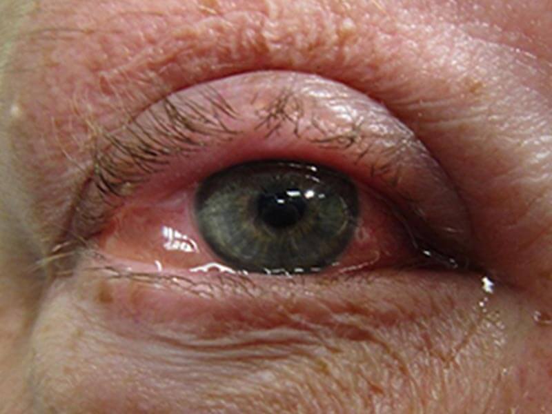 Uveitis Treatment in Ayurveda: Natural Eye Inflammation Relief