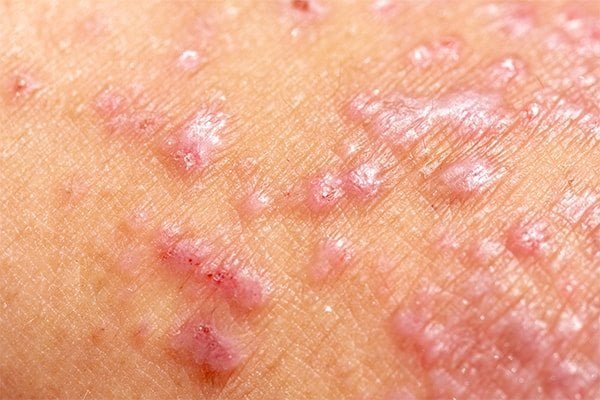 Psoriasis Treatment in Ayurveda: Natural Cure, Symptoms, Causes