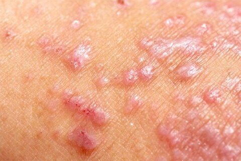 Eczema Treatment in Ayurveda | Permanent & Natural Treatment