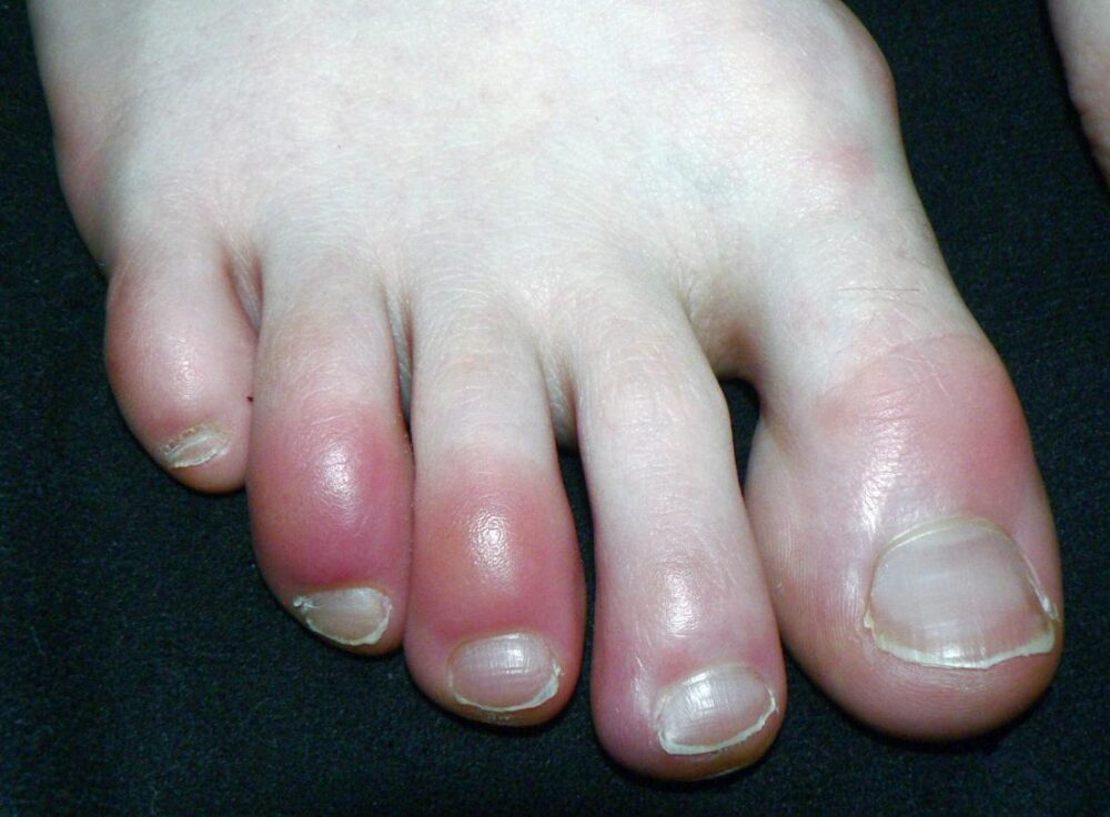 Gout Treatment in Ayurveda | Consult Online for Natural Cure