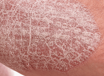 Psoriasis Treatment in Ayurveda: Natural Cure, Symptoms, Causes