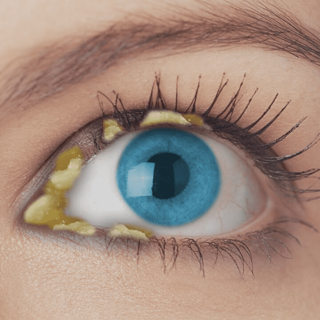 Blepharitis Treatment in Ayurveda | Treat Eyelid Inflammation
