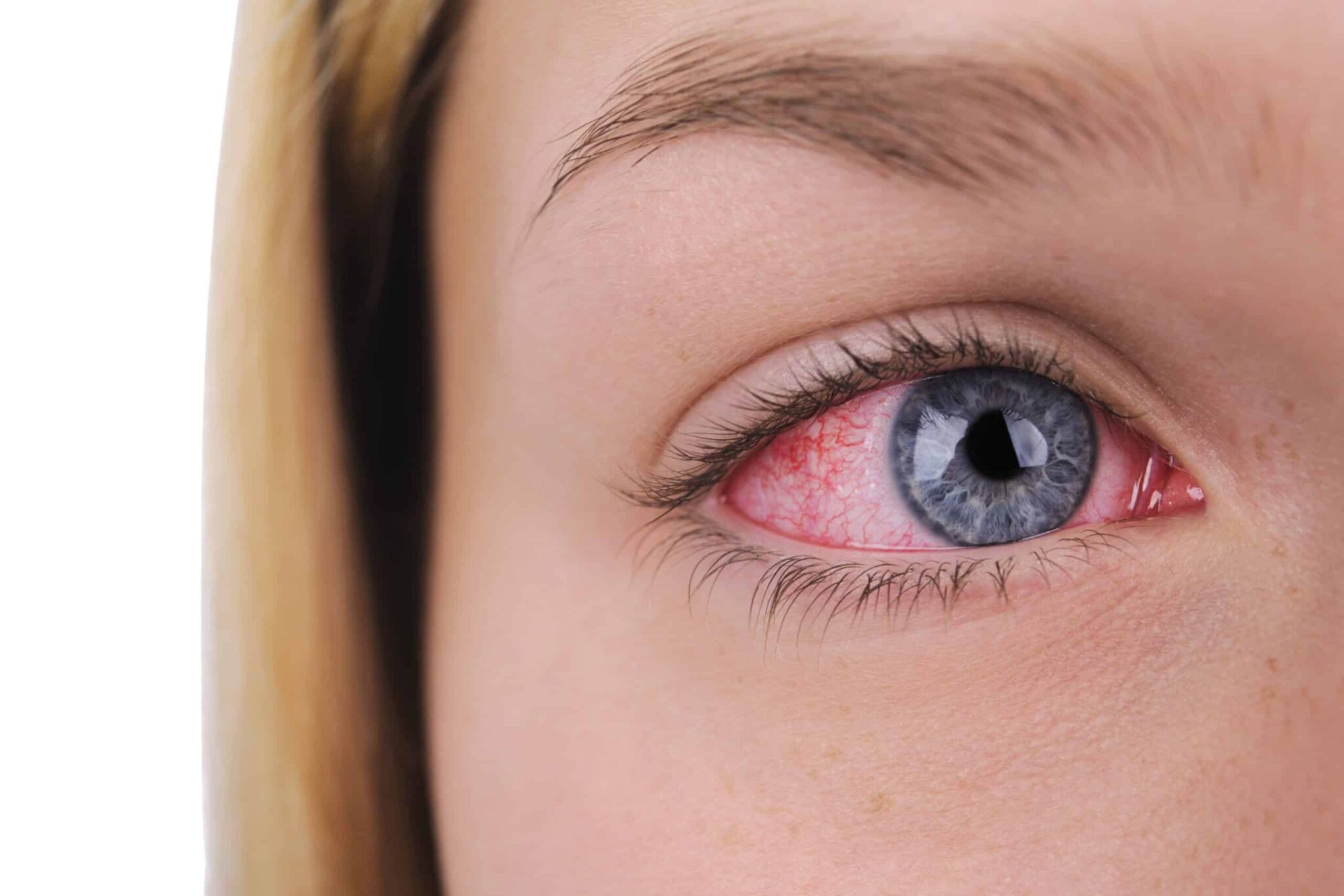 Uveitis Treatment in Ayurveda: Natural Eye Inflammation Relief