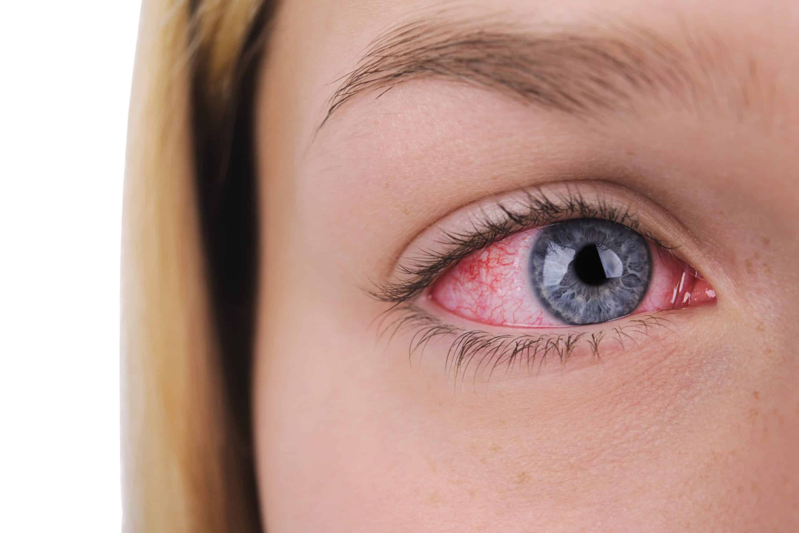 Uveitis Treatment in Ayurveda: Natural Eye Inflammation Relief