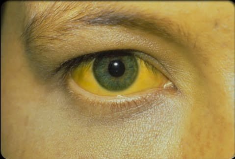 Jaundice: Symptoms, Diagnosis & Permanent Treatment in Ayurveda