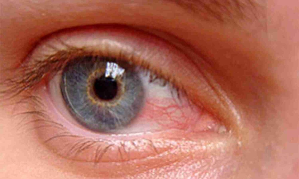 Pterygium Treatment in Ayurveda: Holistic Care for Your Eyes