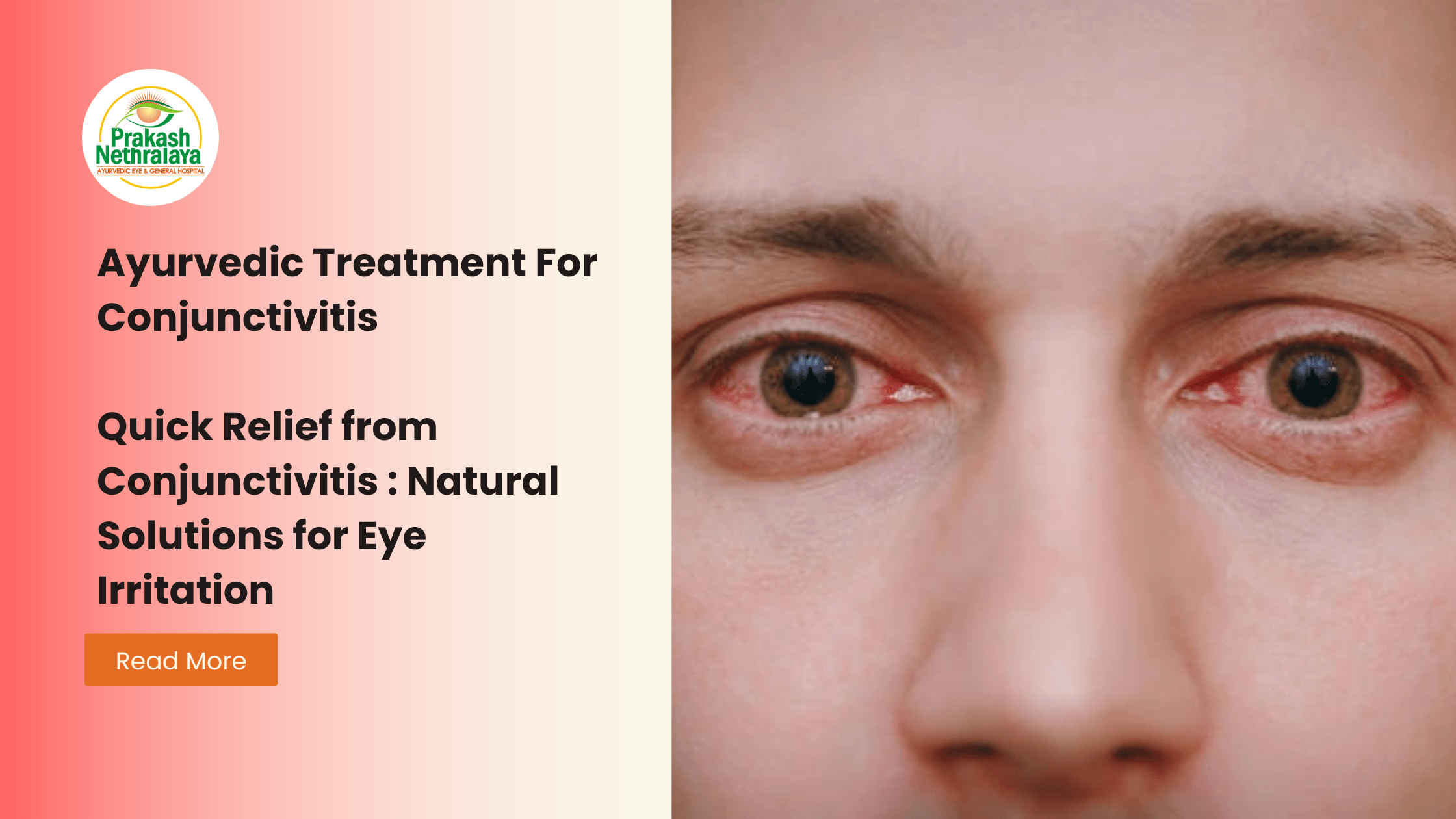 Quick Relief from Conjunctivitis: Natural Eye Remedies