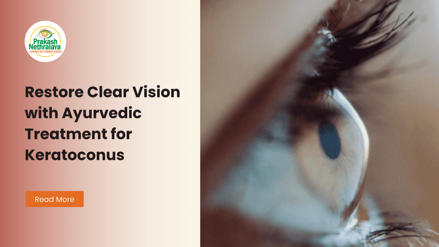 Ayurvedic Keratoconus Treatment for Clearer Vision